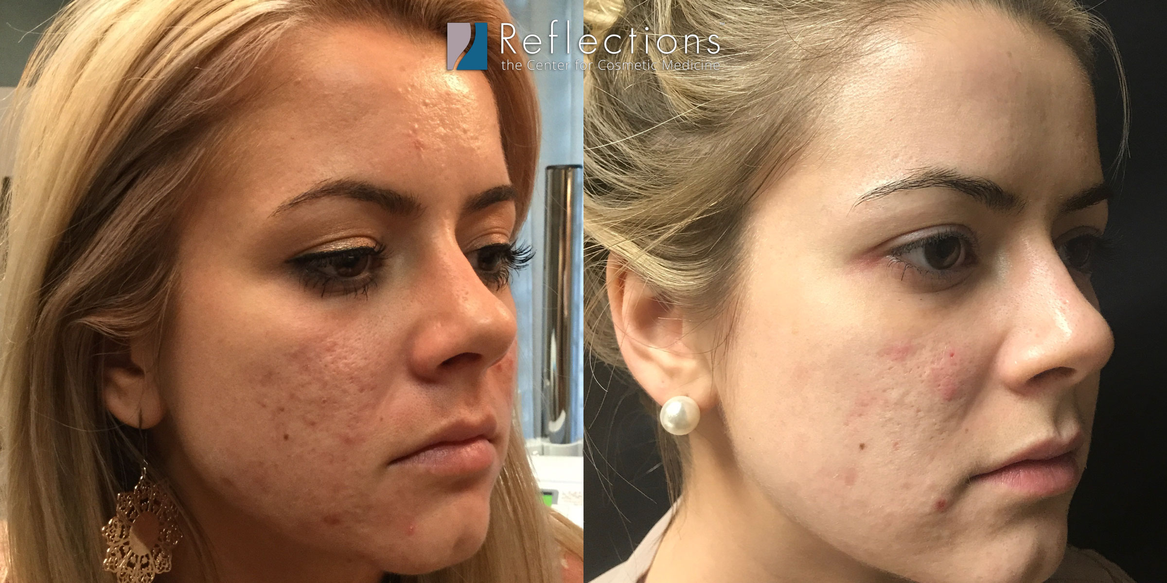 Microneedling At Home Before And After Acne Scars Clearance Cheapest ... Microneedling At Home Before And After Acne Scars Clearance Cheapest ...