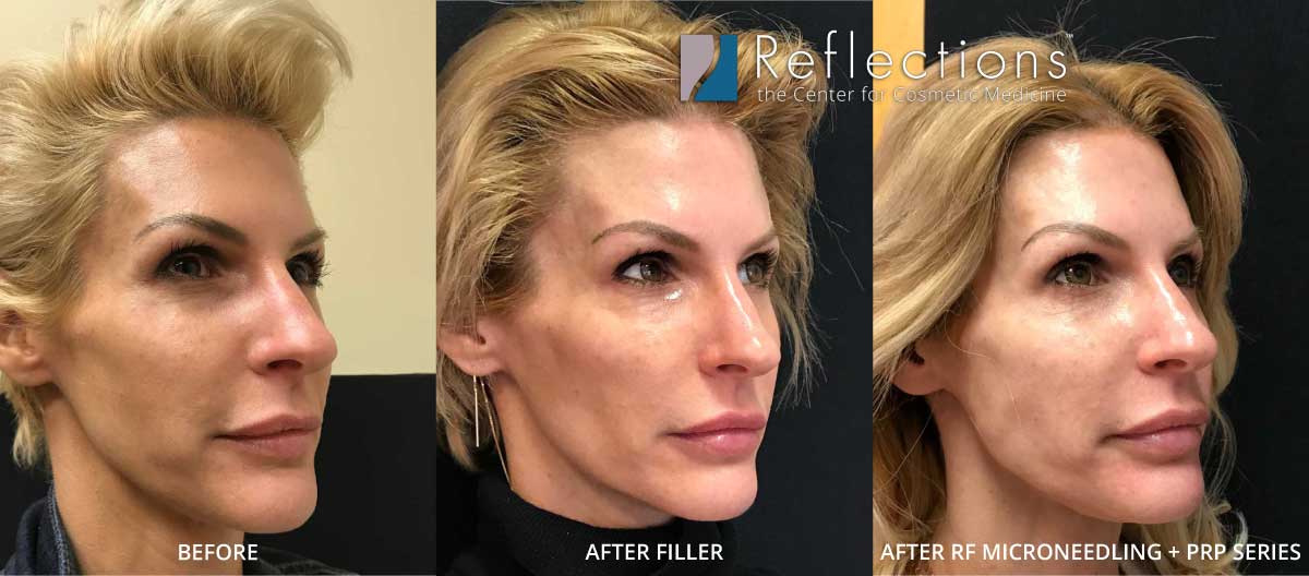 Rf Microneedling Cascade Eye Skin Centers Edu Svet Gob Gt