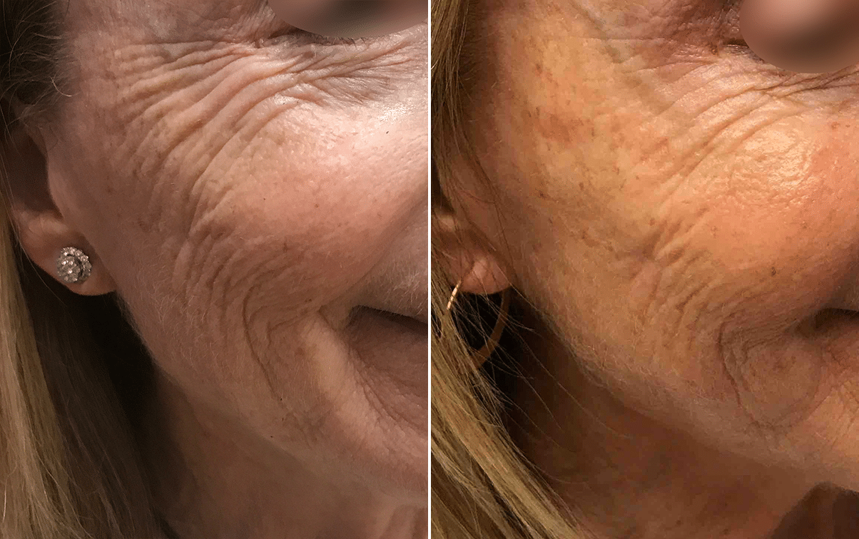 Radiesse Before And After Jowls