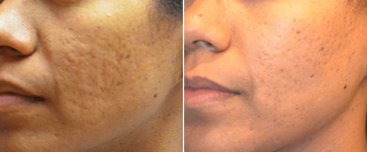 Acne Scars On Black Skin Acne Scars On Black Skin
