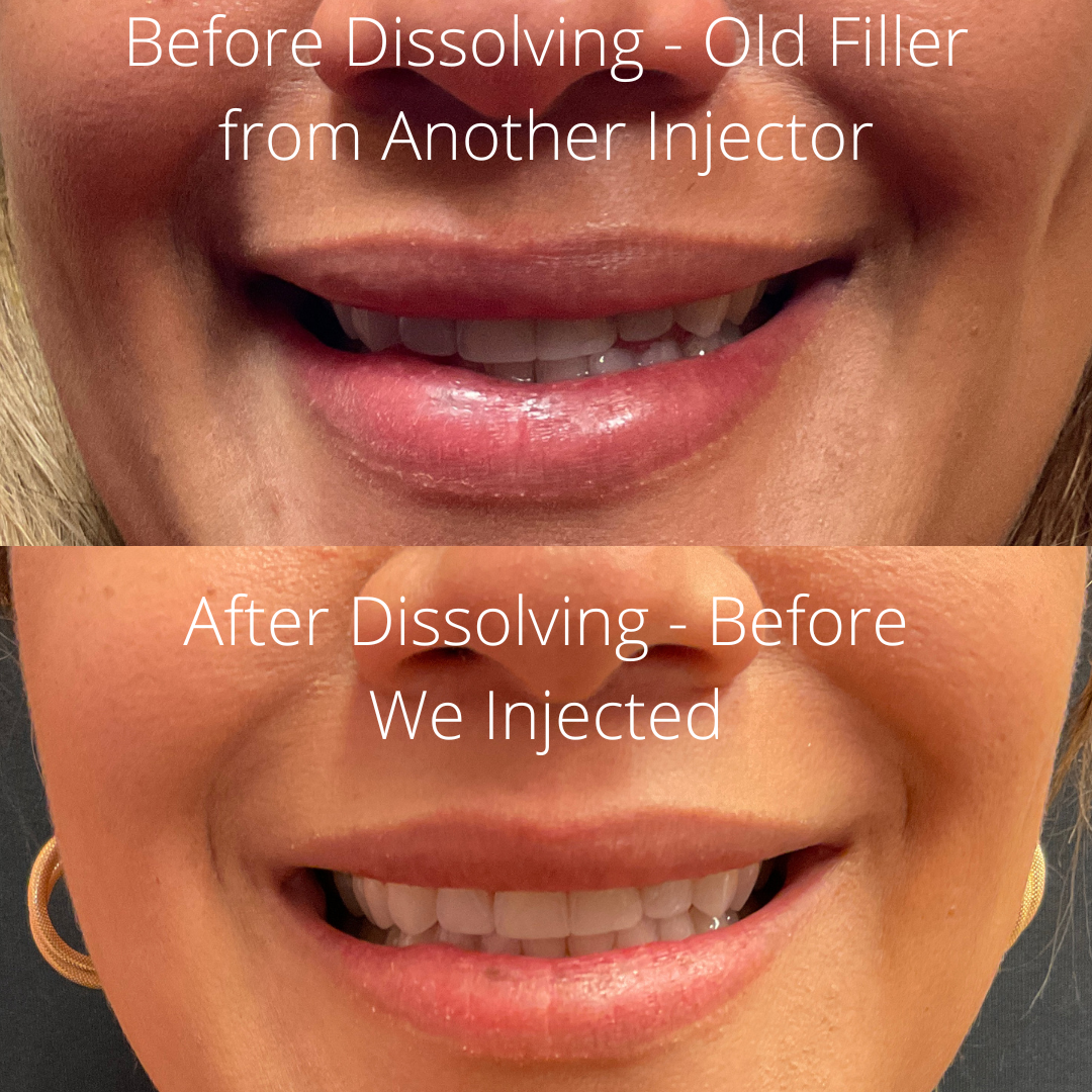 Kysse Lip Filler for Asian Woman's Lips Before & After Photos New ...