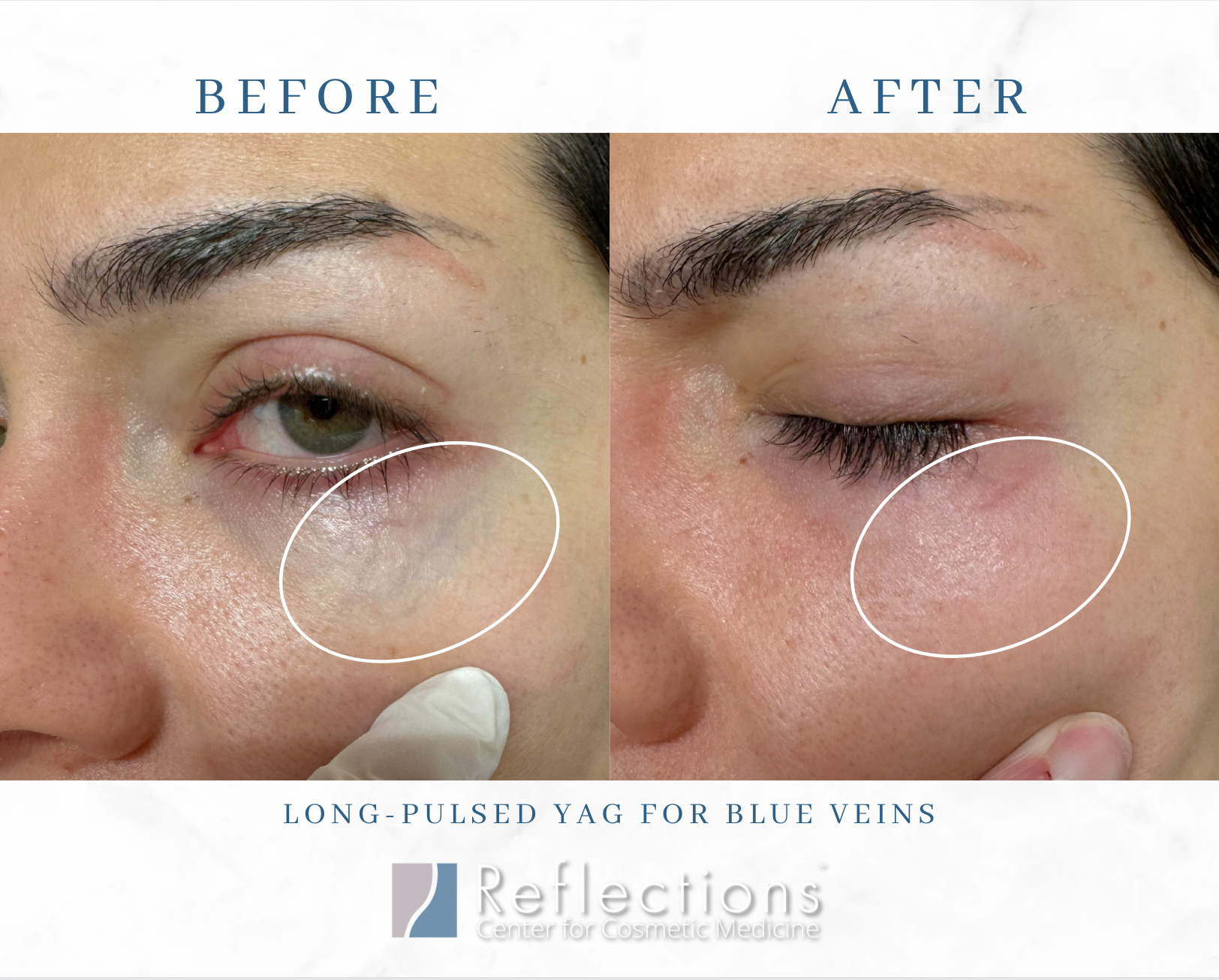 Long Pulsed Yag 24-yo Female Before & After Photos New Jersey ...