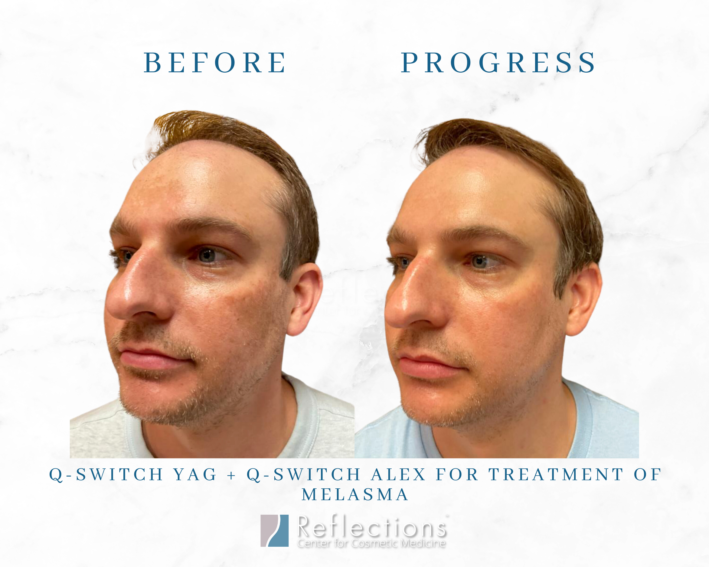 Q-Switch Yag 38-yo Male Before & After Photos New Jersey - Reflections Center