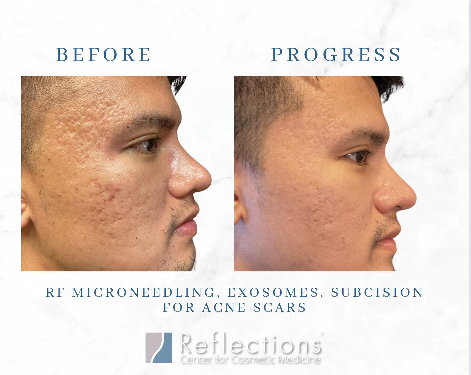 RF Microneedling 27-yo Male Before & After Photos New Jersey ...