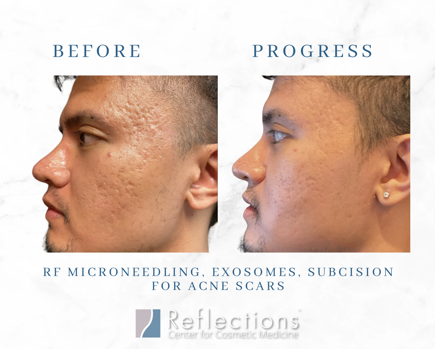 RF Microneedling 27-yo Male Before & After Photos New Jersey ...