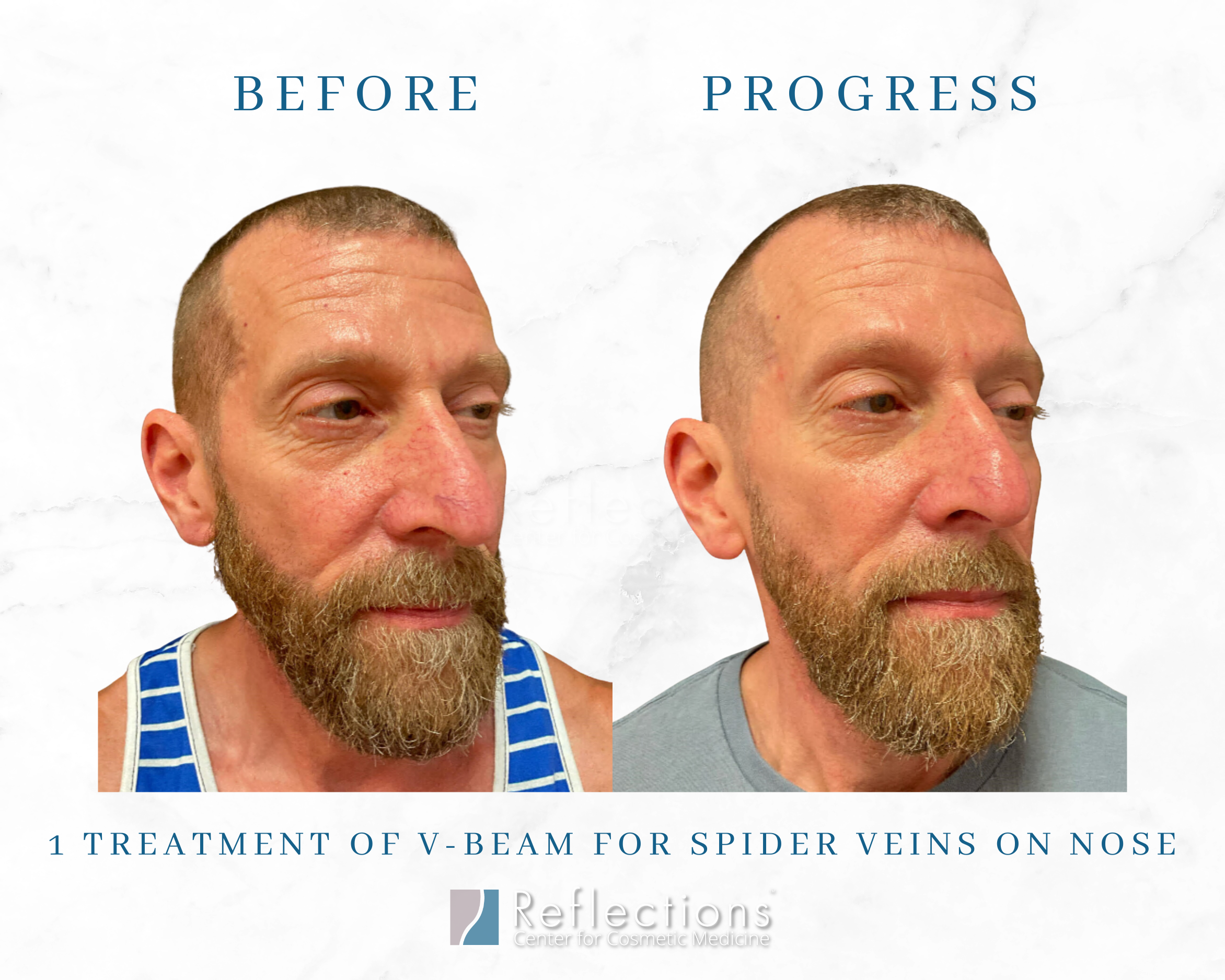 VBeam Spider Veins 58-yo Male Before & After Photos New Jersey ...