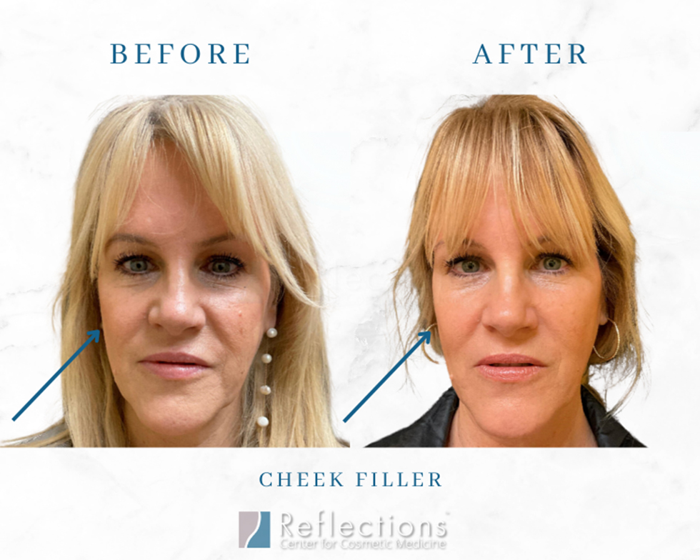 1cc Voluma Cheek Filler 53 yo Female Before & After Photos New Jersey ...