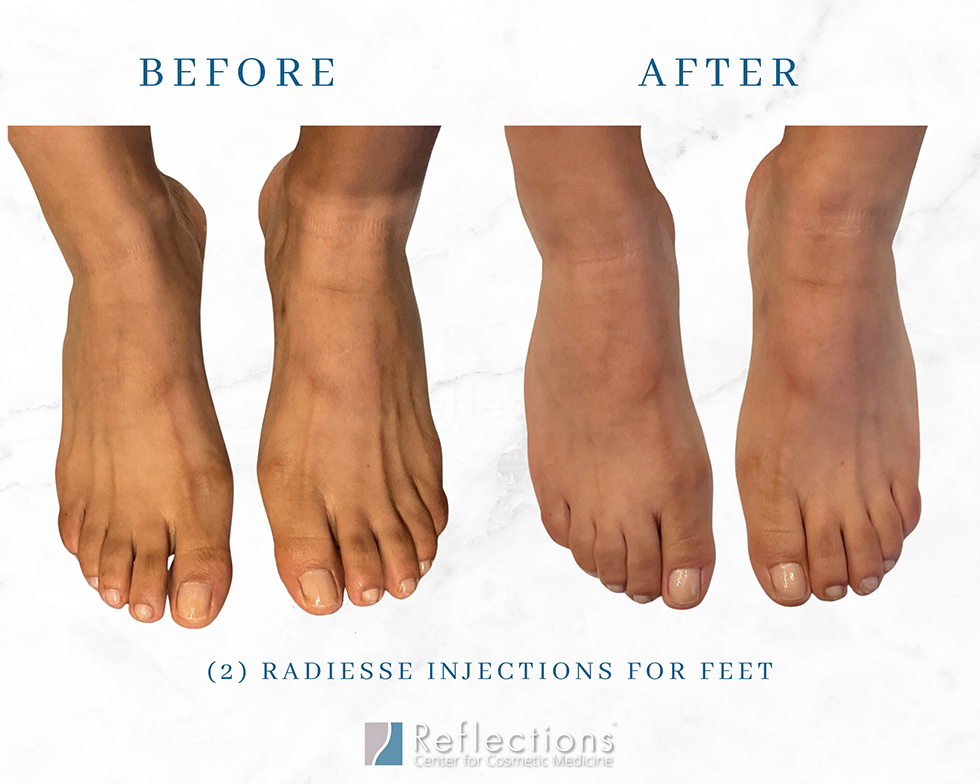 2-Radiesse Injections Foot Rejuvenation 45 yo-Female Before & After ...