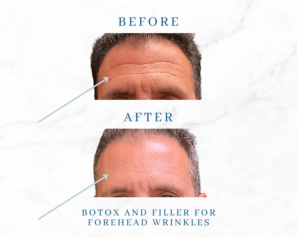 Botox Forehead Wrinkles 59 yo-Male Before & After Photos New Jersey ...