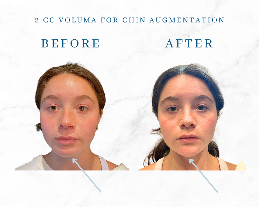 Chin Filler 2cc Voluma 20 yo Female Before & After Photos New Jersey ...