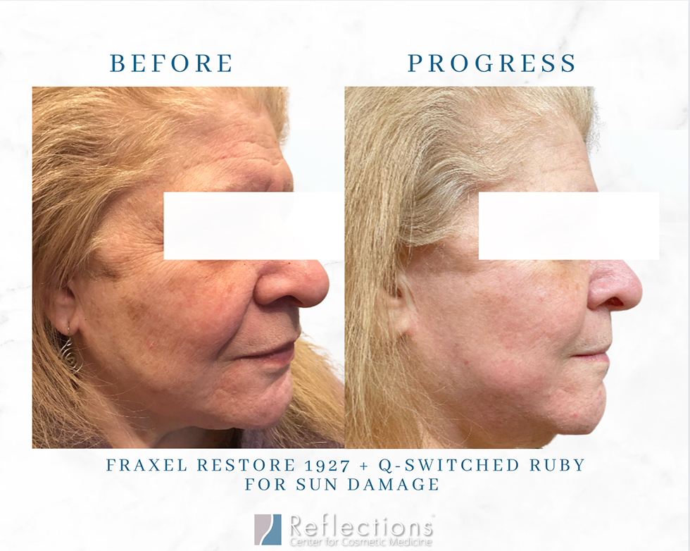 Fraxel Restore 1927 QSR Laser For Sun Damage 71 yo Female Before ...