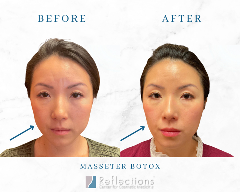 Masseter Botox 38 yo Female Before & After Photos New Jersey ...