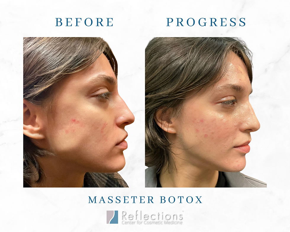 Masseter Botox TMJ Before & After Photos New Jersey - Reflections Center