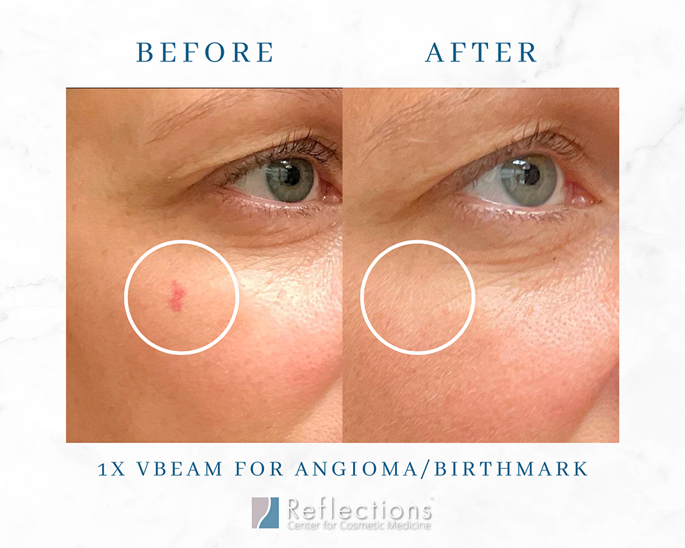Post 1 Vbeam Birthmark Before & After Photos New Jersey - Reflections ...