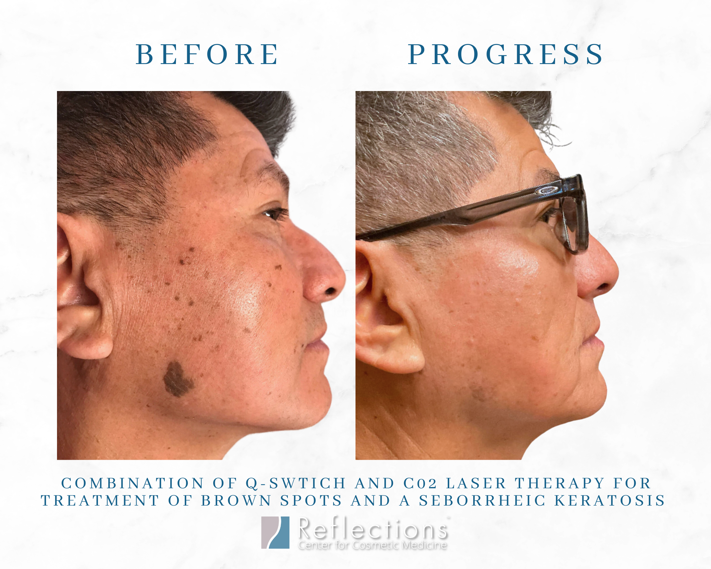 Transforming Skin at 69: How Q-Switch and CO2 Laser Therapy Addressed ...