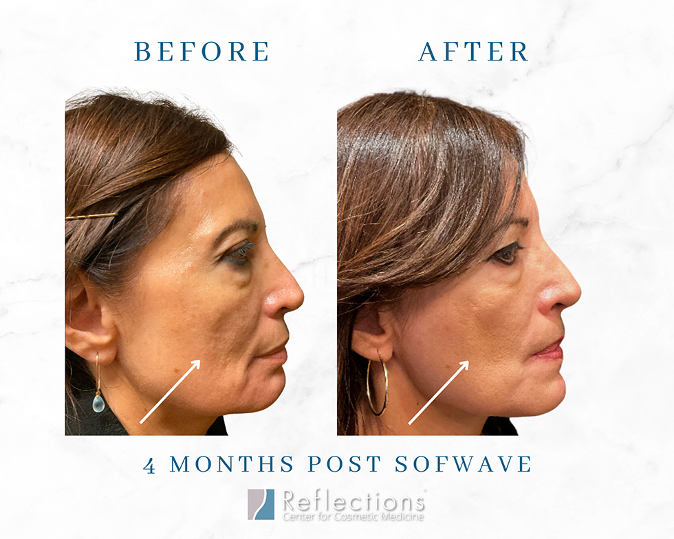 Sofwave 4 Months Post Treatment Before & After Photos New Jersey ...