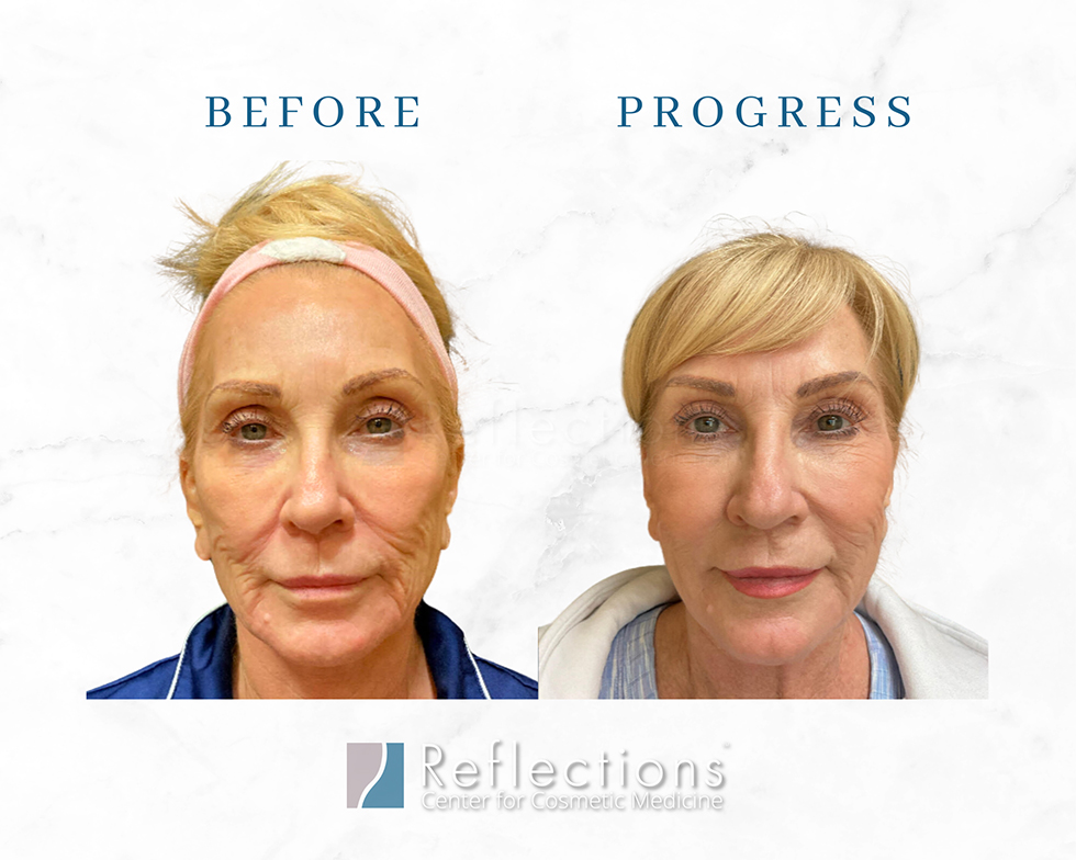 Sofwave Radiesse Full Face Before & After Photos New Jersey ...