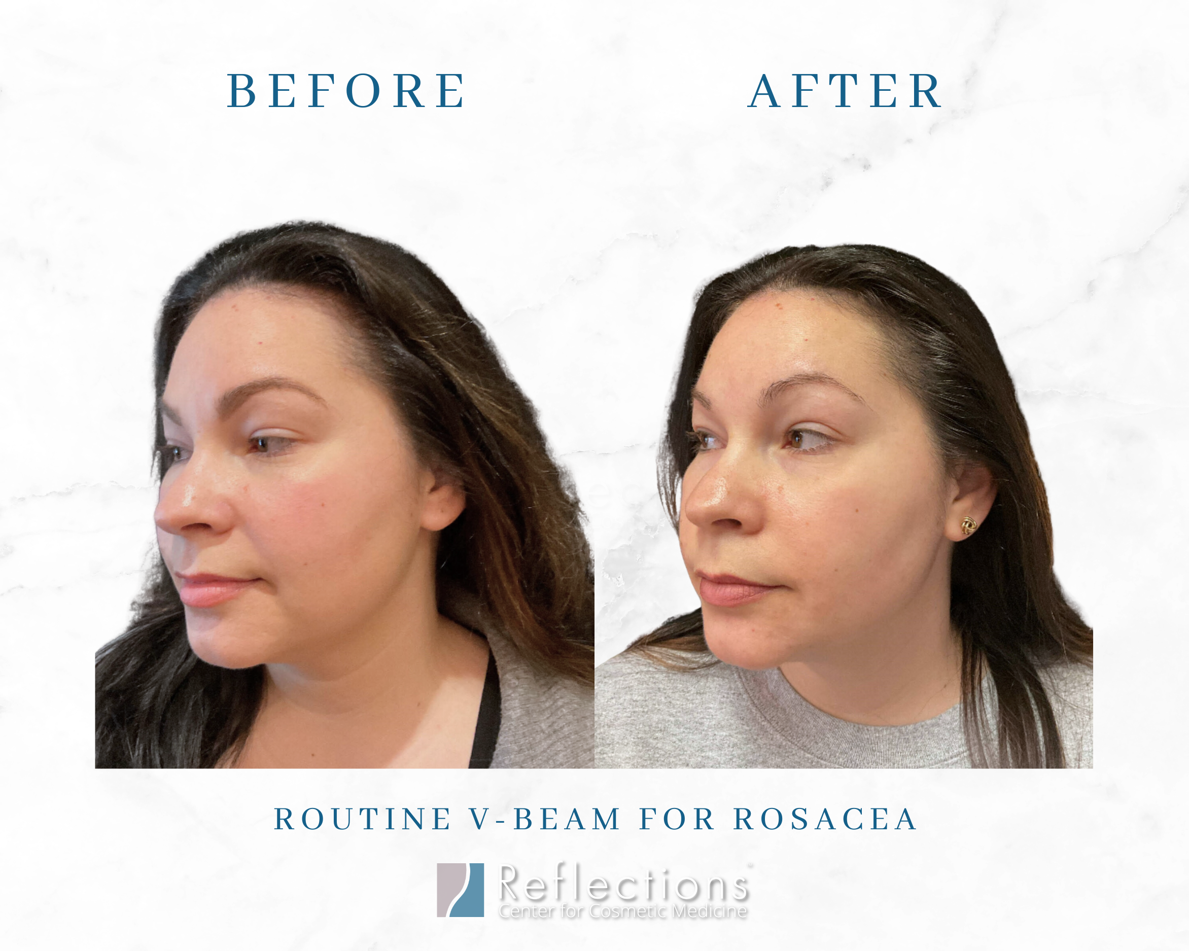 Managing Rosacea with Routine V-Beam Treatments Before & After Photos ...