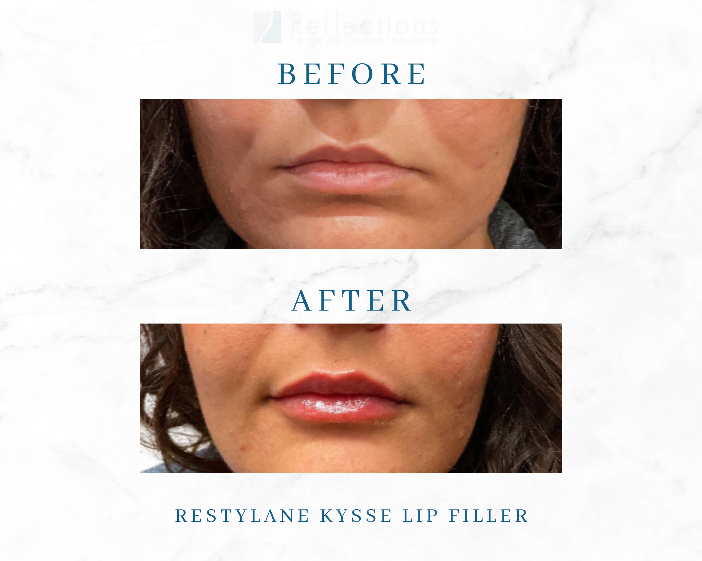 28-Year-Old’s Natural Lip Enhancement with Restylane Kysse Before ...