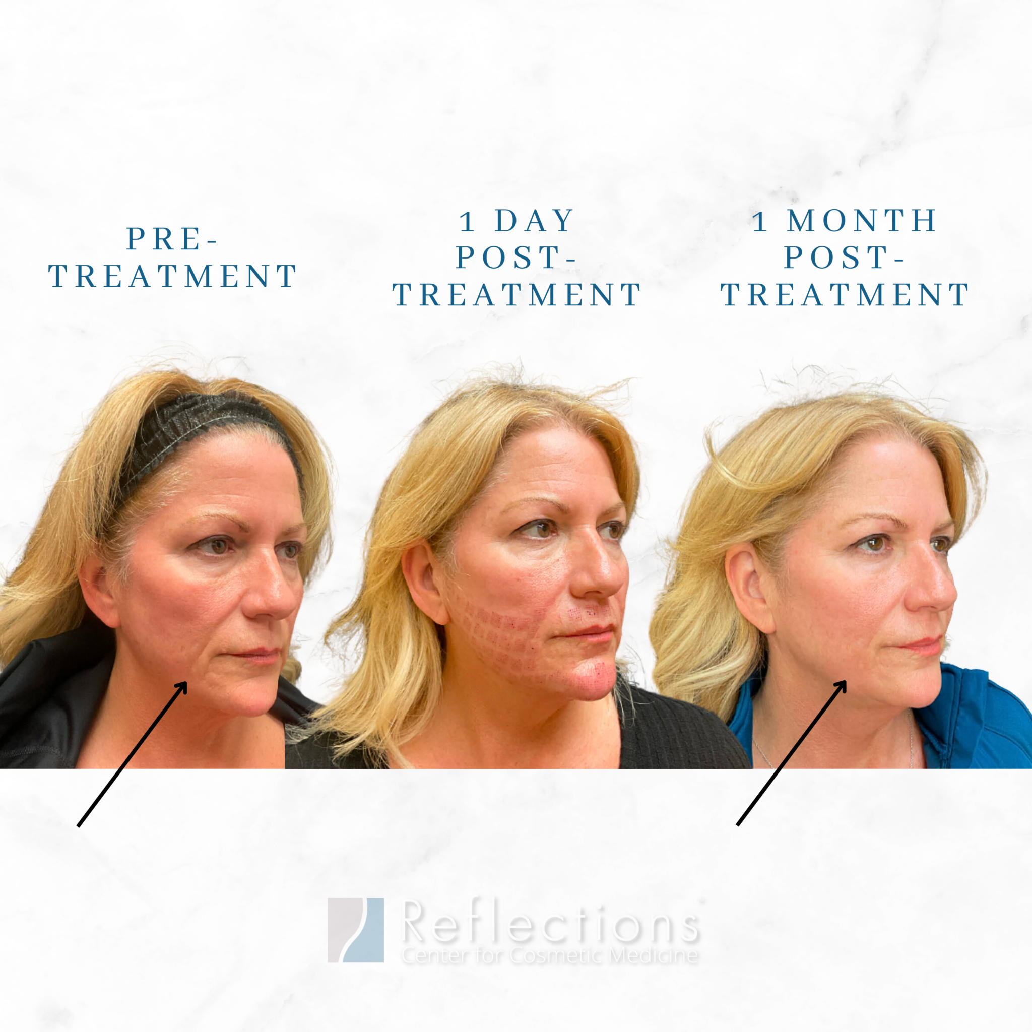 Ellacor Non-Surgical Skin Tightening | Reflections Center NJ