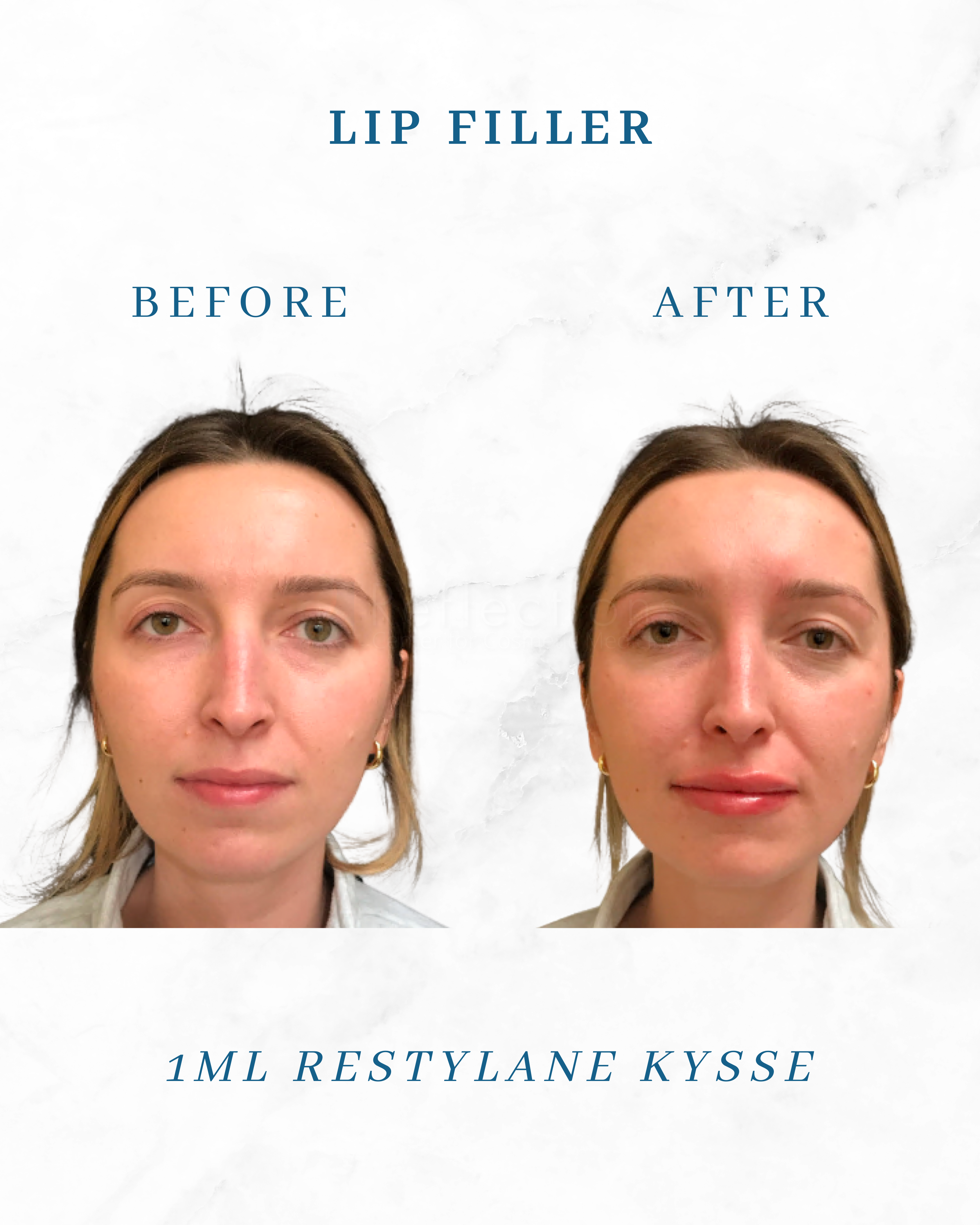 Restylane Kysse Lip Filler 28 yo Female Before & After Photos New ...