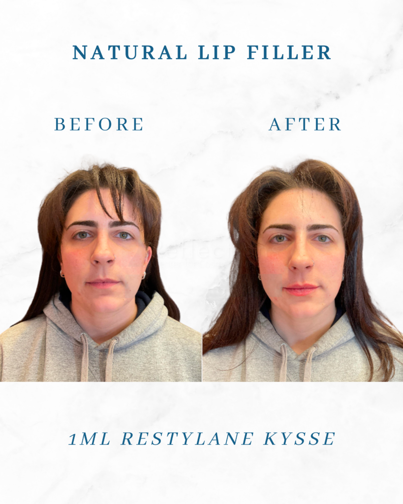 Lip Filler Restylane Kysse 29 YO Caucasian Female Before & After Photos ...