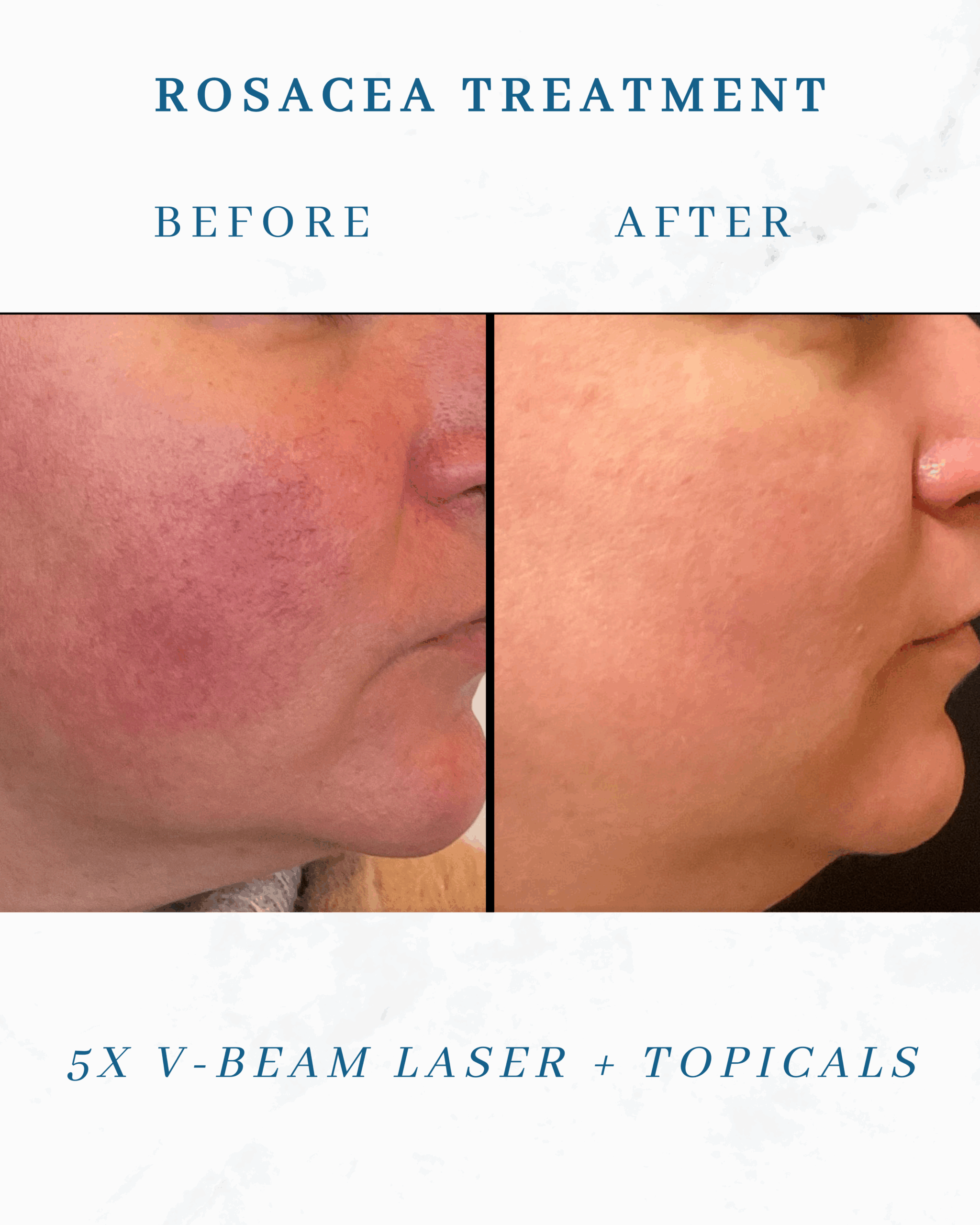 VBeam Rosacea Treatment Topicals 41 yo Caucasian Female Before & After ...