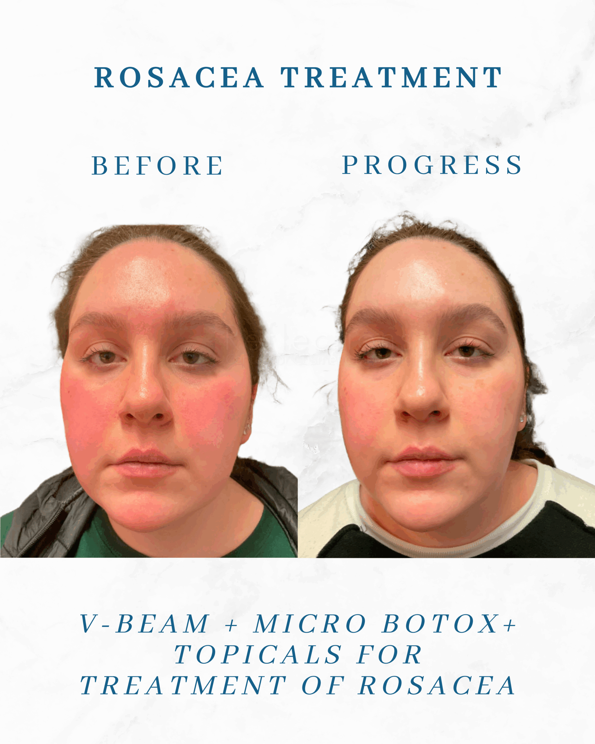 VBeam Topicals Micro Botox Combination Rosacea 26yo Caucasian Female ...