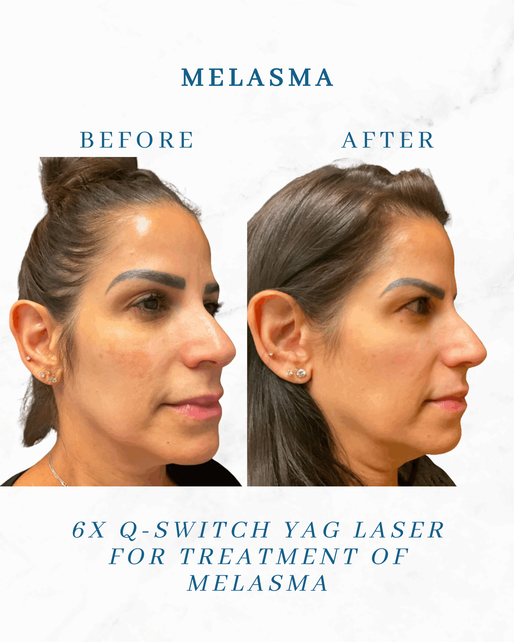 6 Q-Switch YAG Melasma 54 yo Hispanic Female Before & After Photos New ...