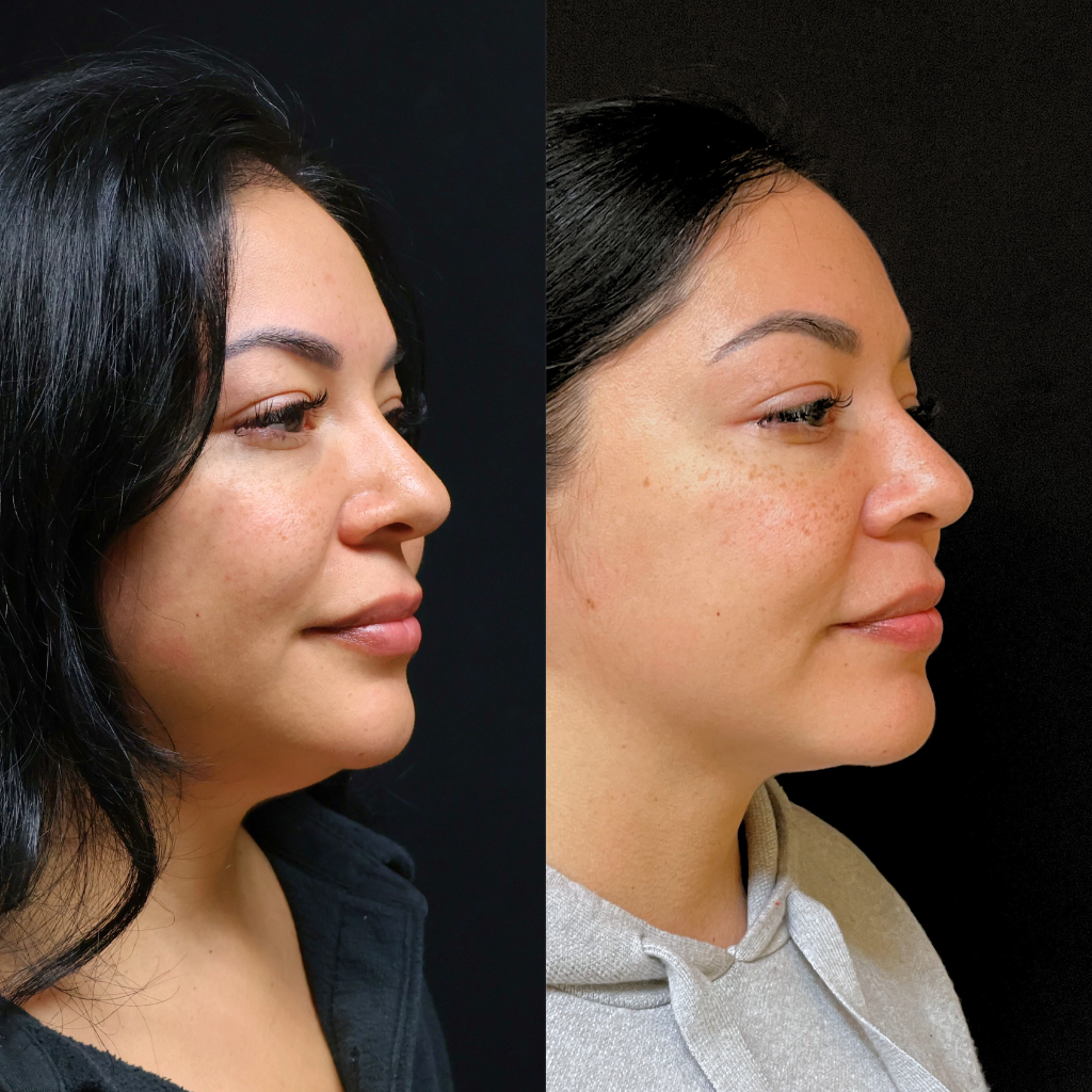 Chin Liposuction 34 yo Female Before & After Photos New Jersey ...