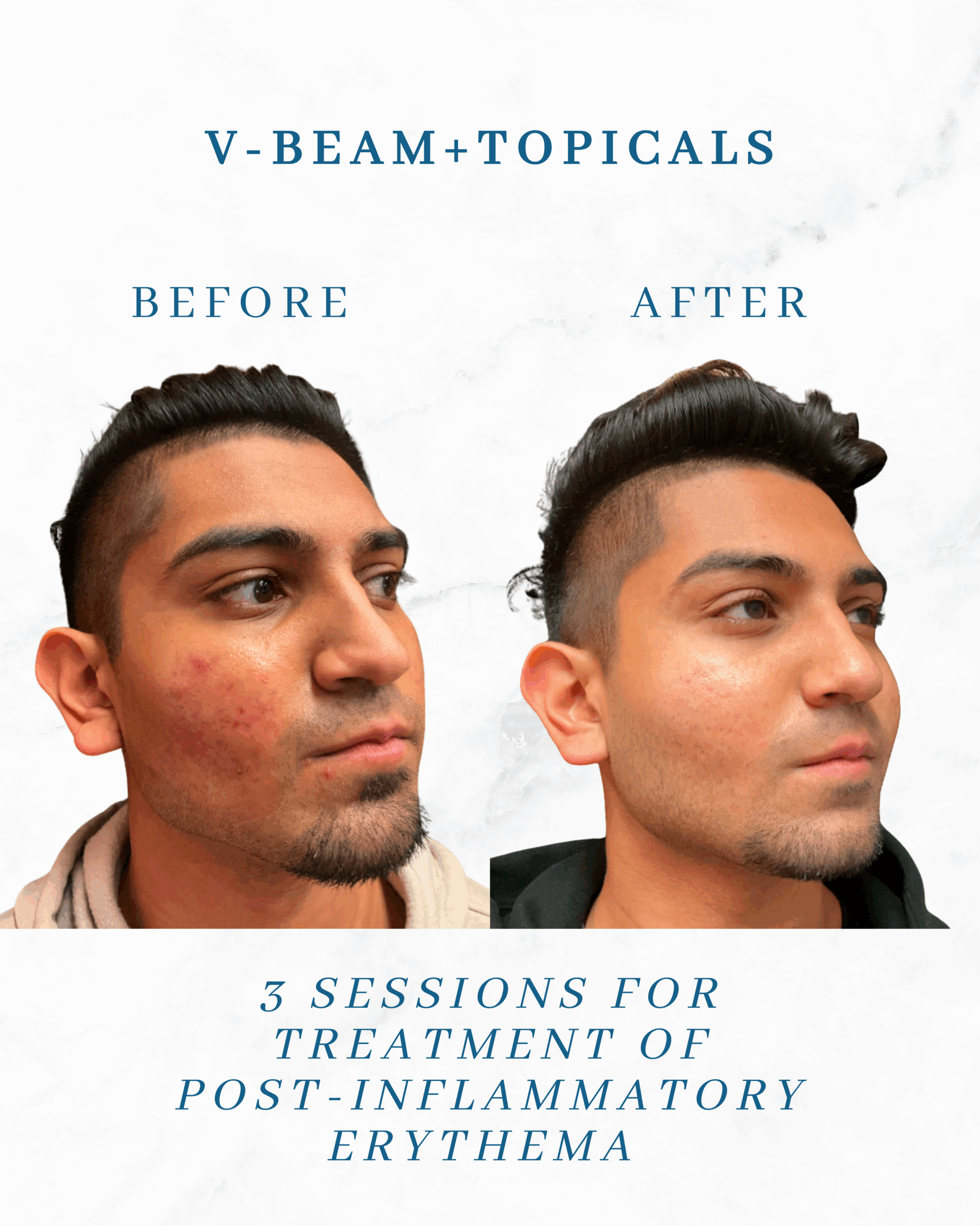 VBeam Acne Redness Topical Treatment 24 yo Arab Male Before & After ...
