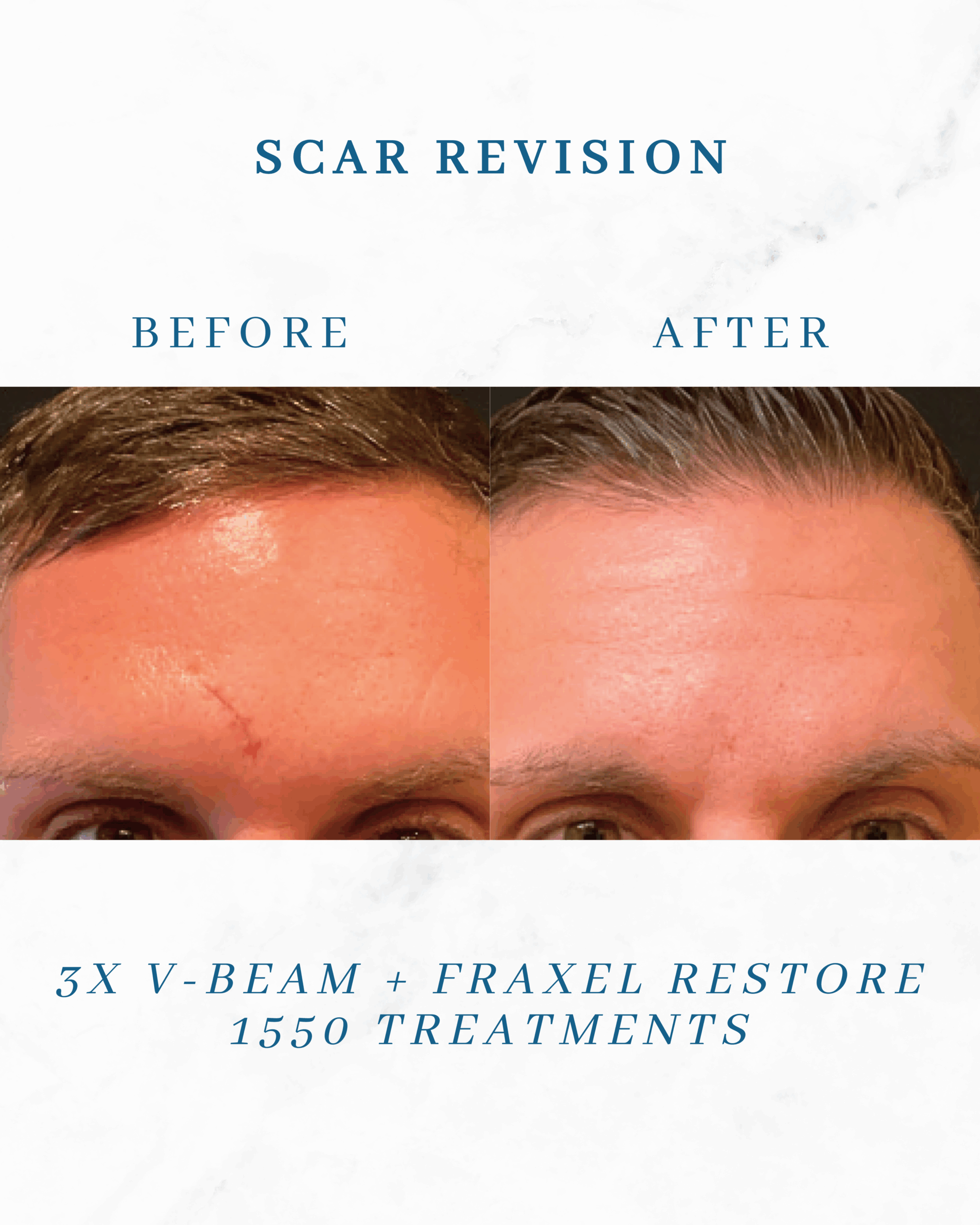 VBeam Fraxel Restore Scar Revision 39 yo Caucasian Male Before & After ...
